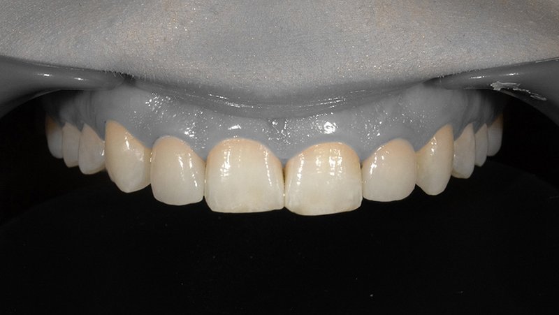 Teilkronen und ästhetische Frontzahnfüllungen | AllDent Karriere